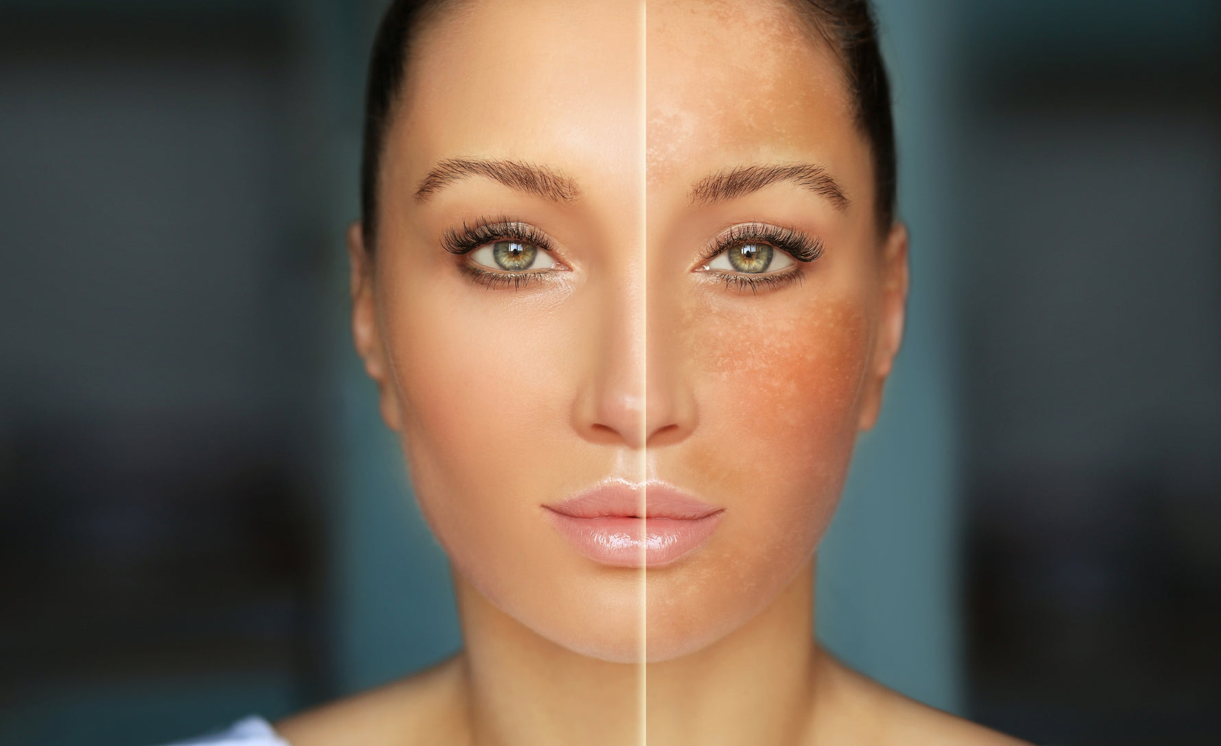 Hyperpigmentation Causes And How To Deal With It – The Skin Story